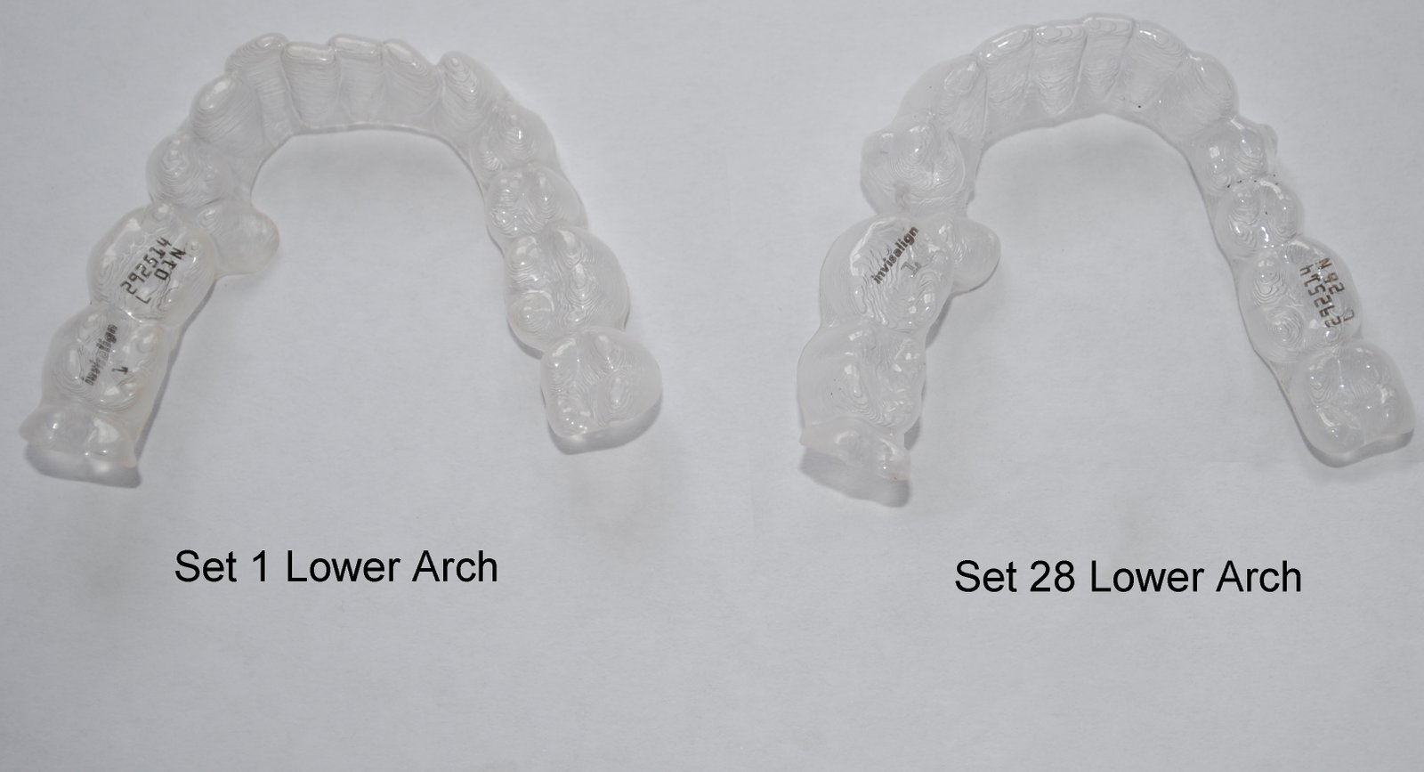 lower arch comparison 28 – My Invisalign Blog