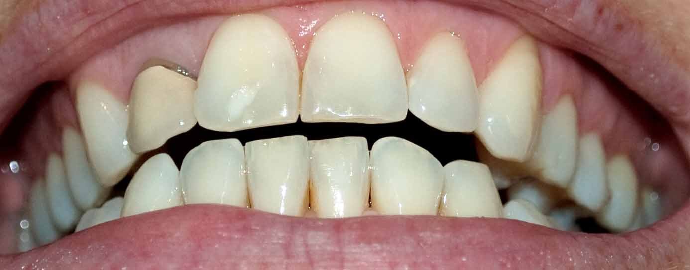 Invisalign Braces Before and After Pictures – update – My Invisalign Blog